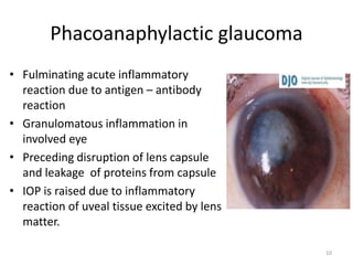 Secondary-glaucoma-Final.pptx