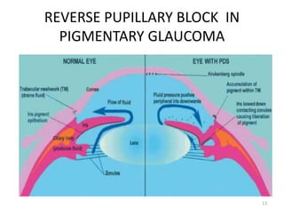 Secondary-glaucoma-Final.pptx