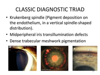 Secondary-glaucoma-Final.pptx