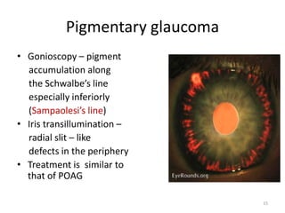 Secondary-glaucoma-Final.pptx