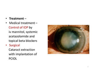 Secondary-glaucoma-Final.pptx