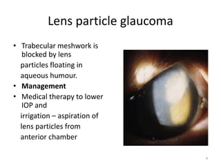 Secondary-glaucoma-Final.pptx