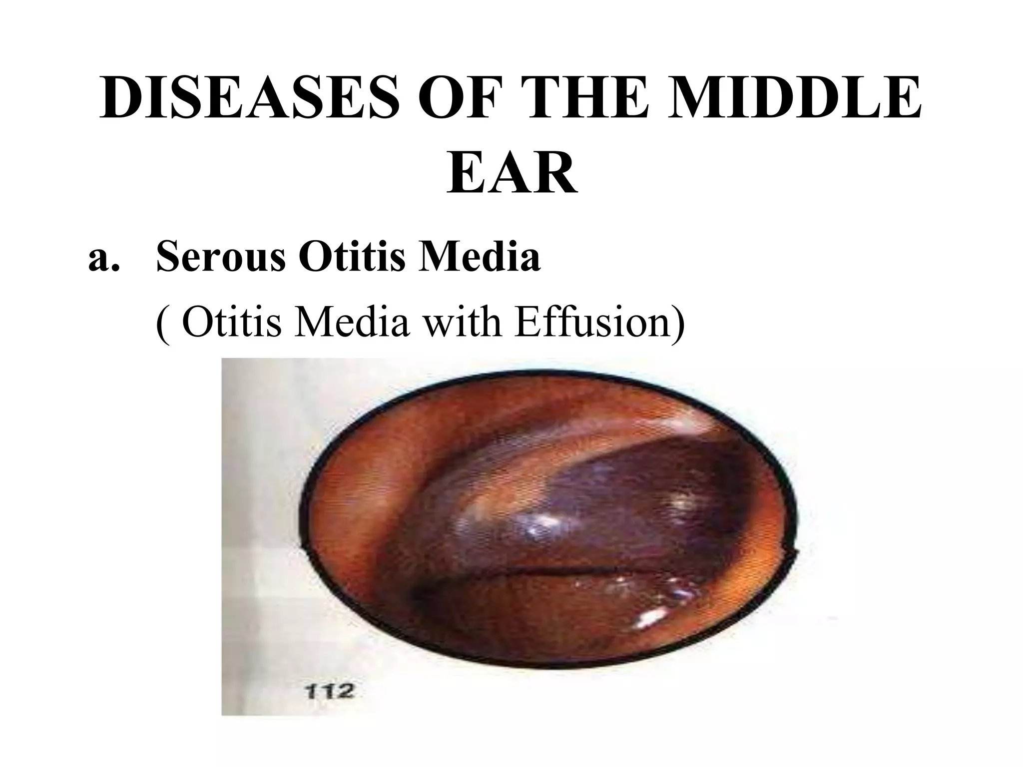 Common Ear Diseases | PDF