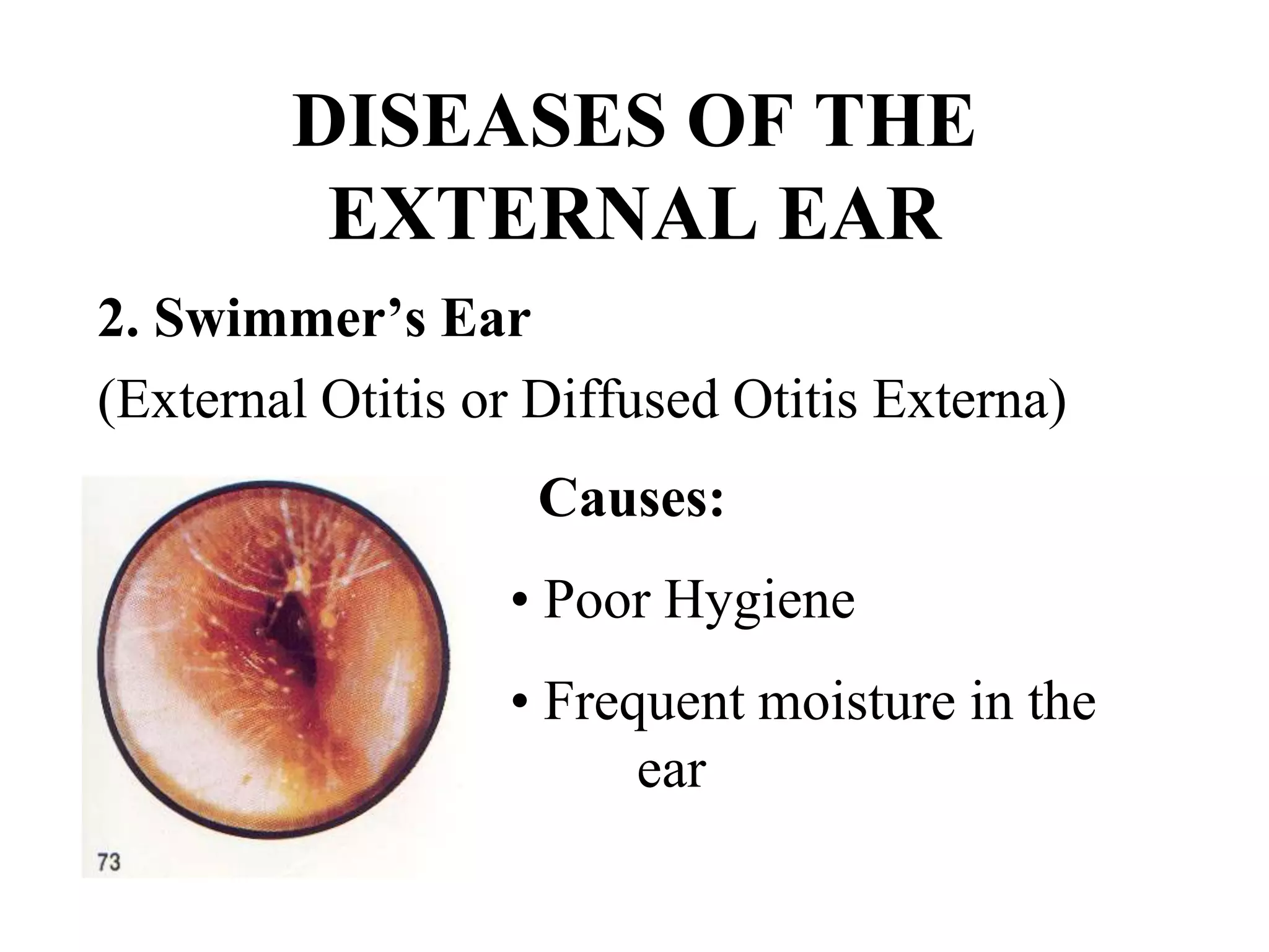 Common Ear Diseases | PDF