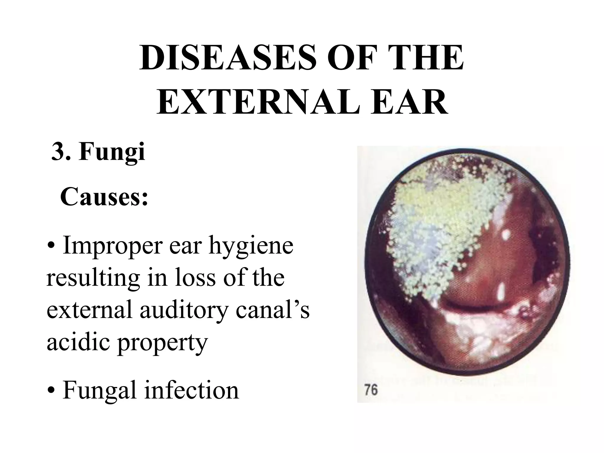 Common Ear Diseases | PDF