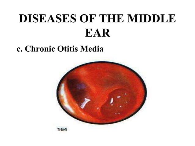 Common Ear Diseases | PPT
