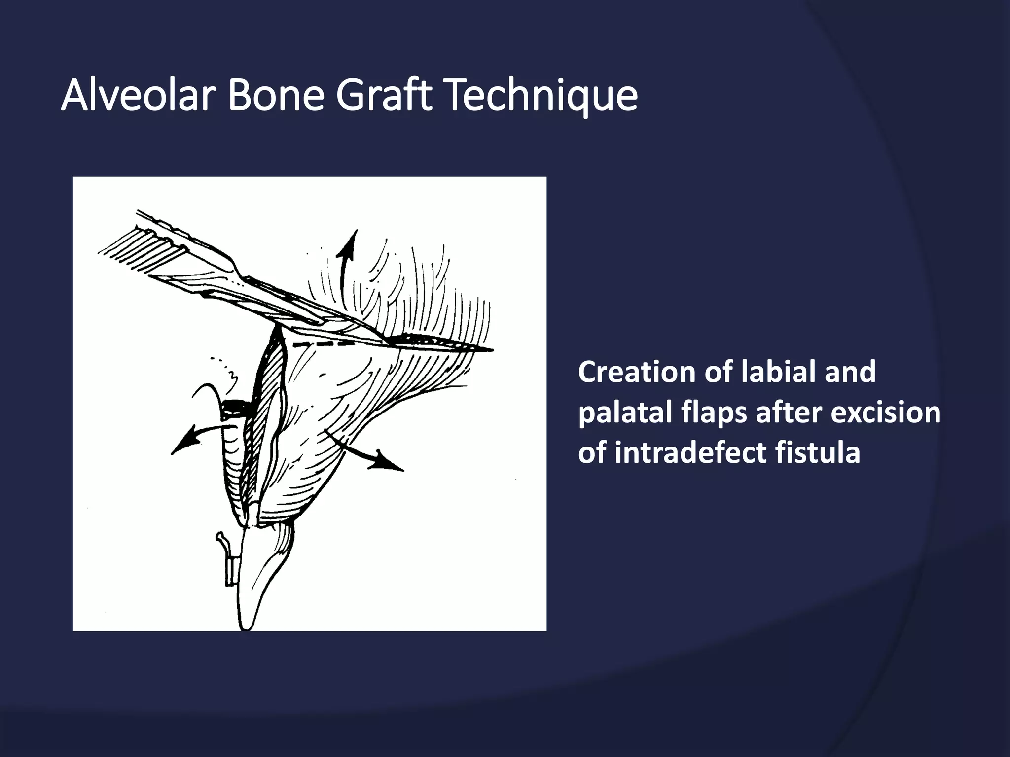 Secondary alveolar bone grafting | PPTX