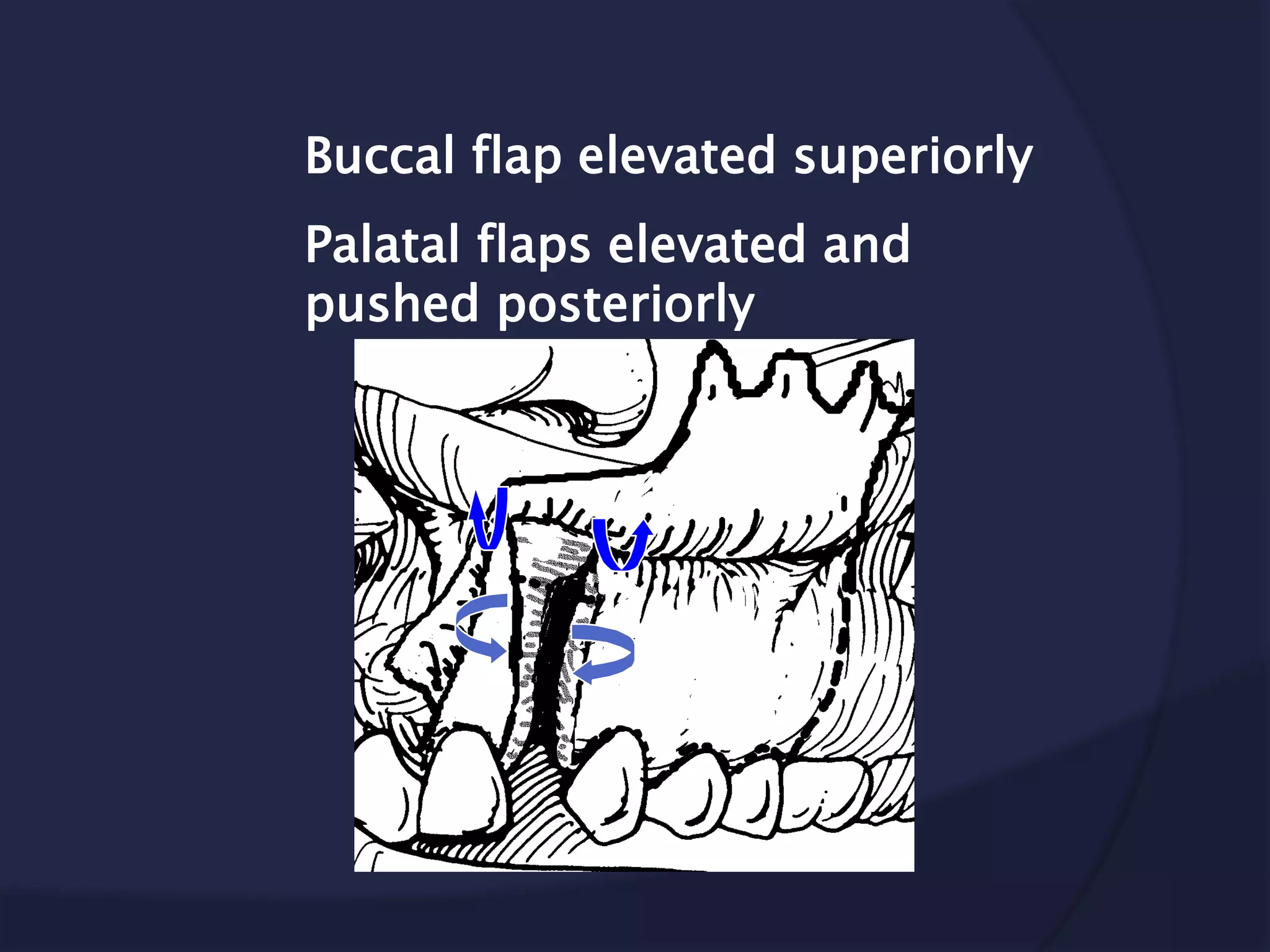 Secondary alveolar bone grafting | PPTX