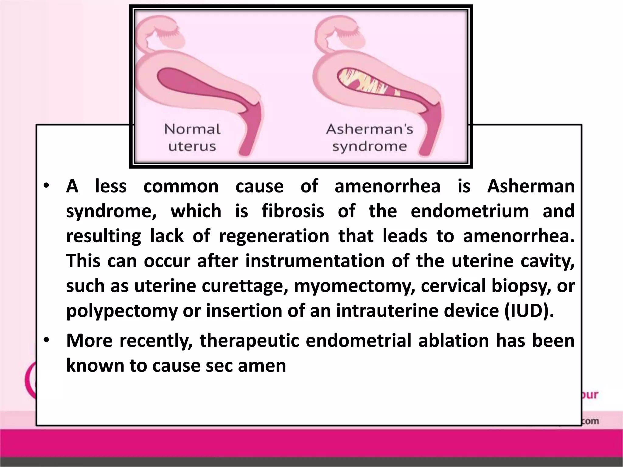 Secondary amenorrhoea by dr alka mukherjee dr apurva mukherjee | PPTX