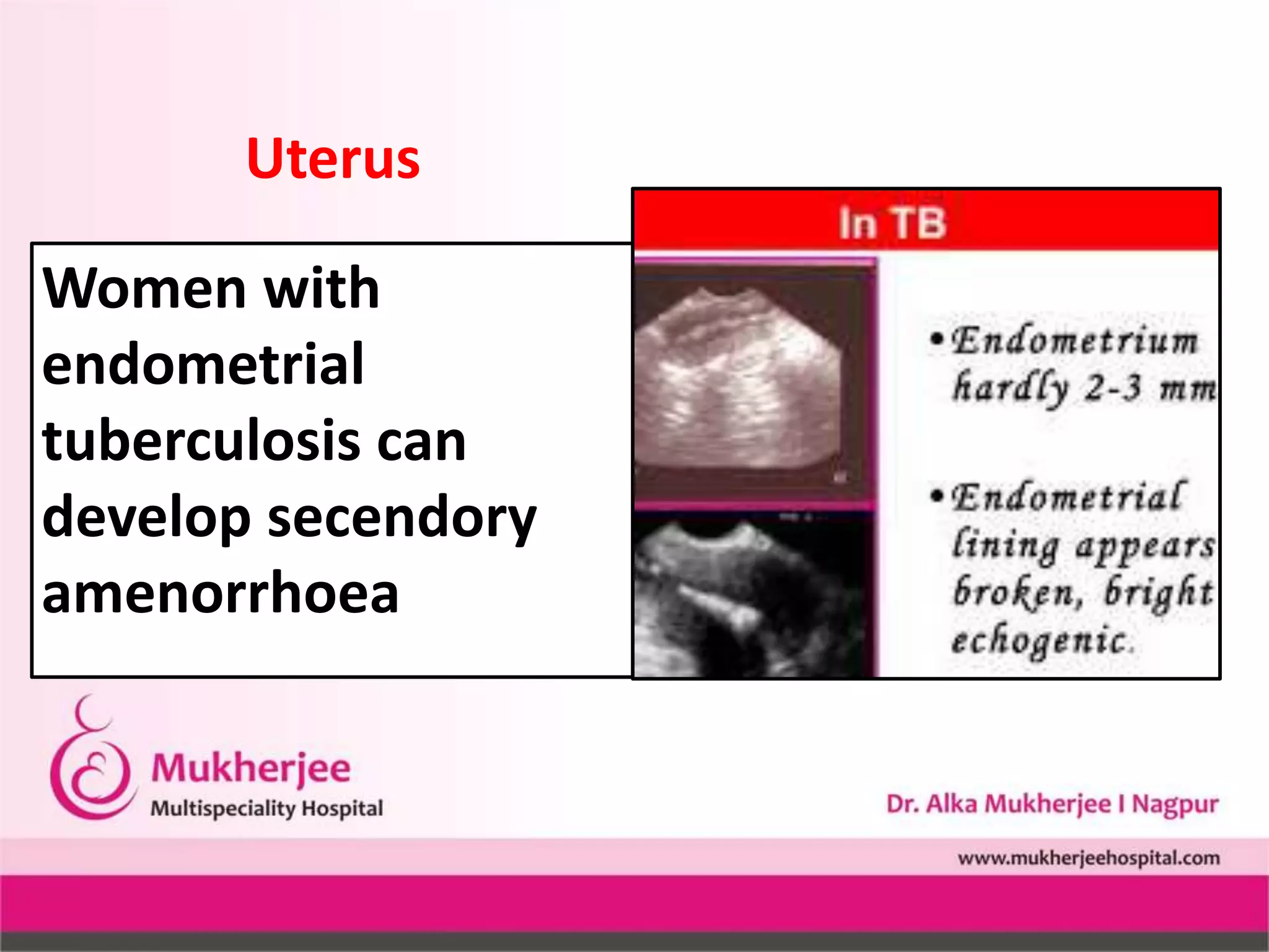 Secondary amenorrhoea by dr alka mukherjee dr apurva mukherjee | PPTX