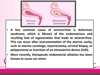 Secondary amenorrhoea by dr alka mukherjee dr apurva mukherjee | PPTX