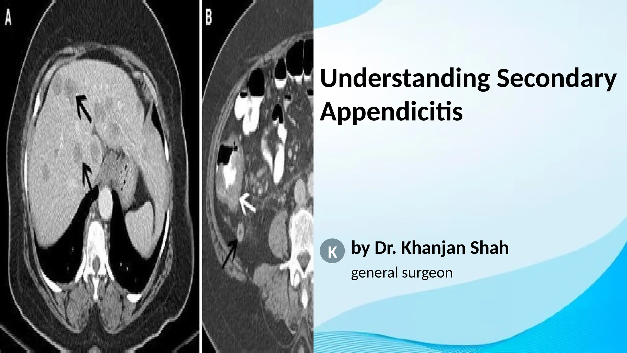 Secondary Appendicitis and causes -2.pptx