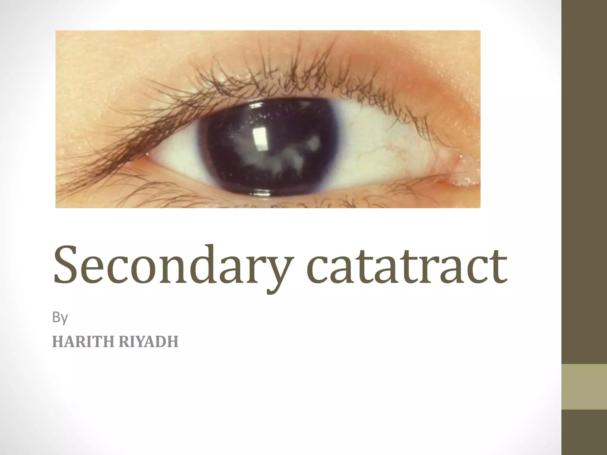 Secondary cataract | PPTX