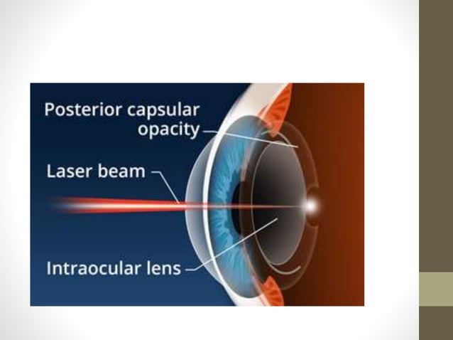 Secondary cataract | PPTX | Eye and Vision Conditions | Diseases and ...