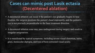 Secondary Corneal Ectasia.pptx