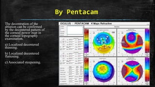 Secondary Corneal Ectasia.pptx