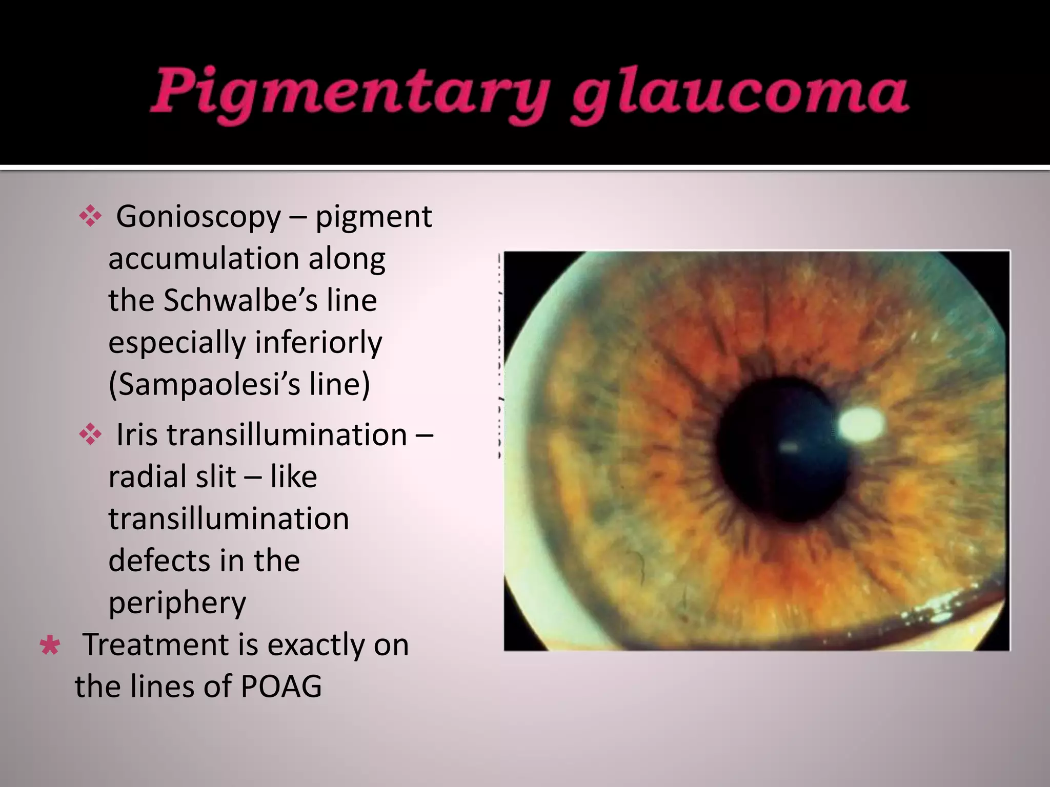 Secondary glaucoma | PPTX