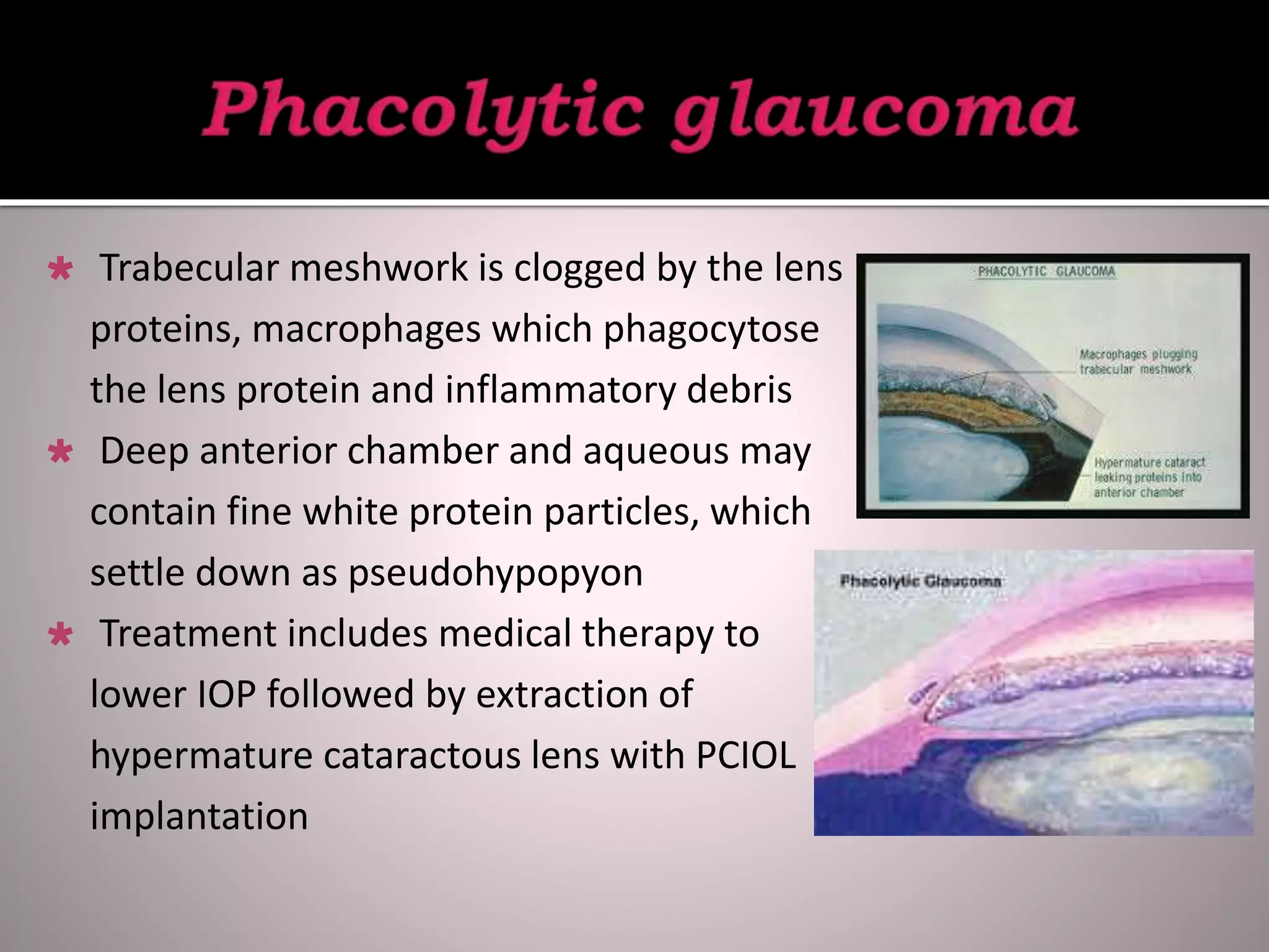 Secondary glaucoma | PPTX