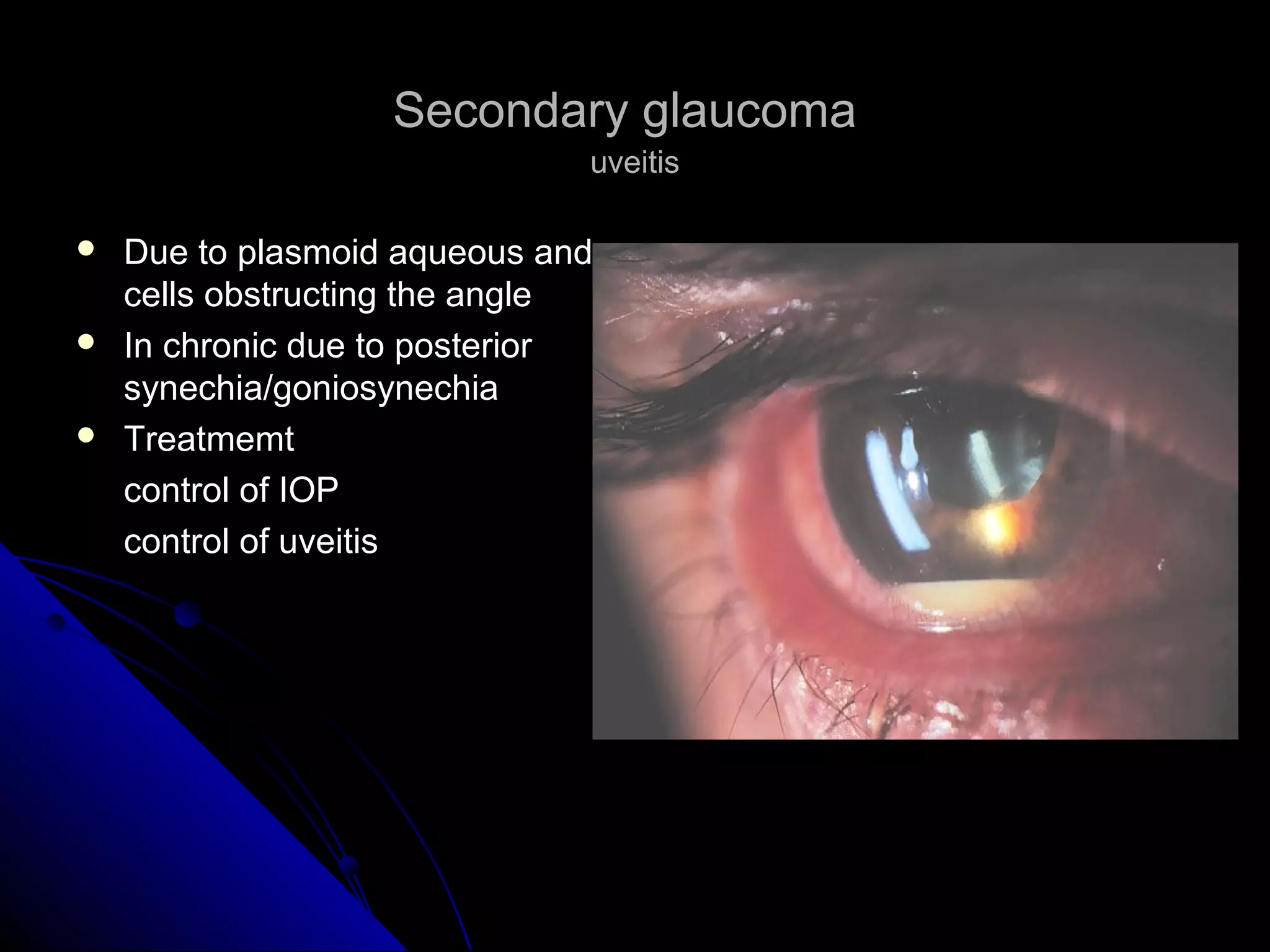 Secondary glaucoma | PPT