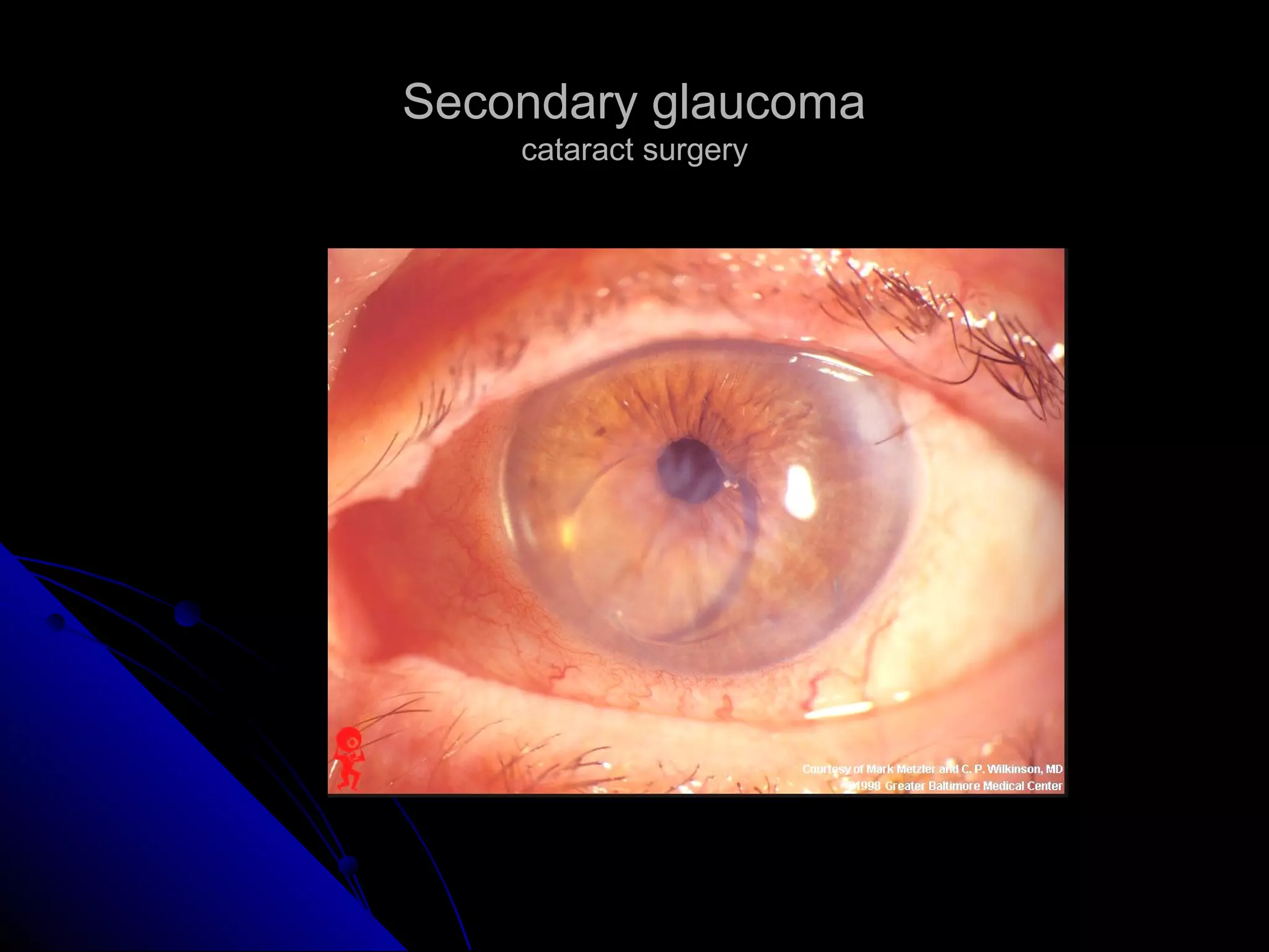 Secondary glaucoma | PPT