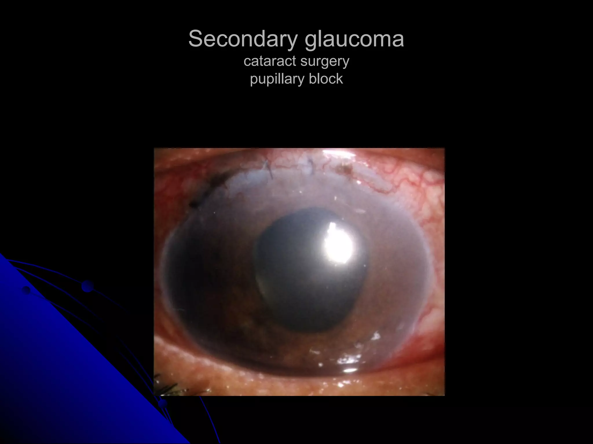 Secondary glaucoma | PPT