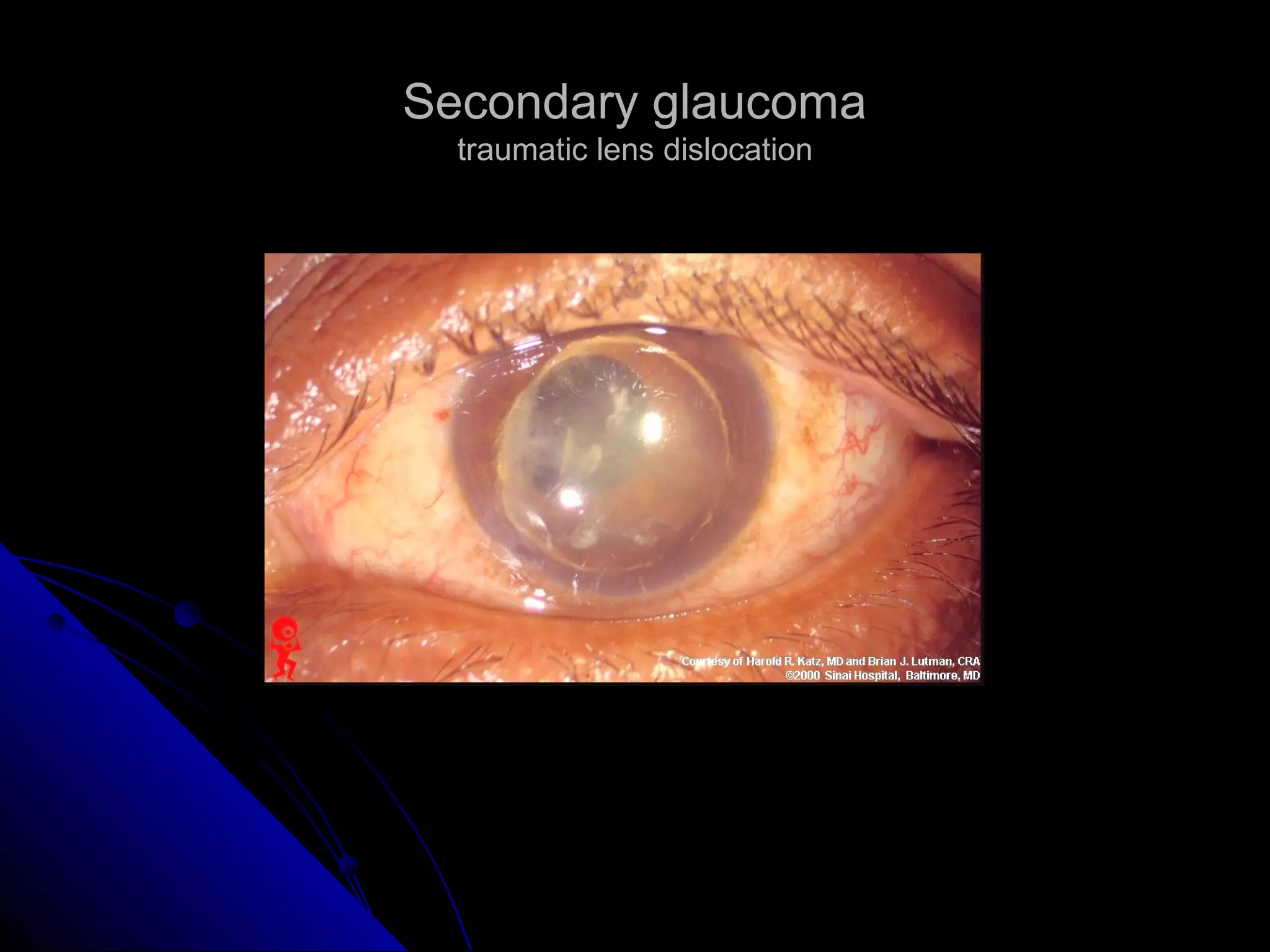 Secondary glaucoma | PPT