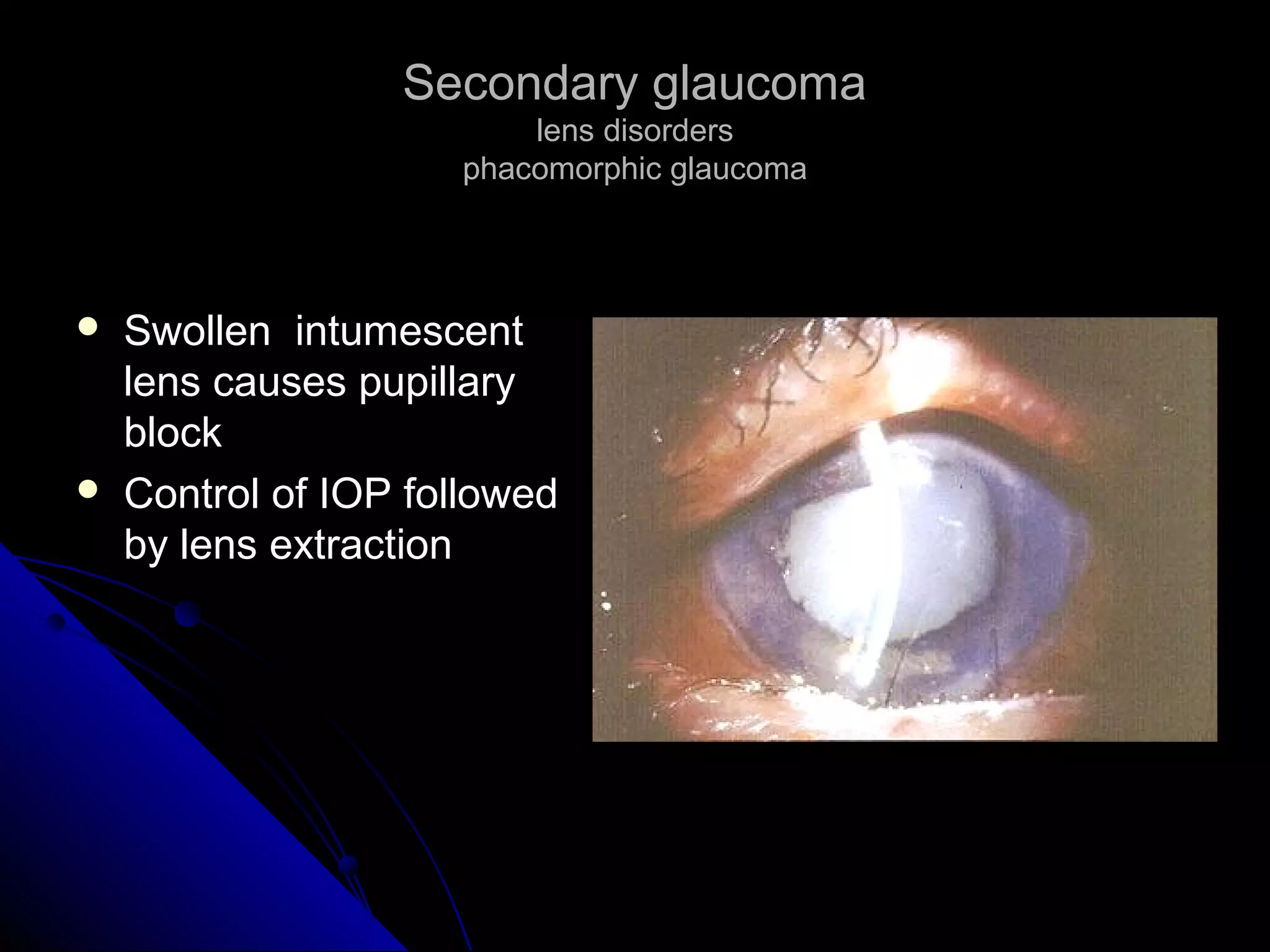 Secondary glaucoma | PPT