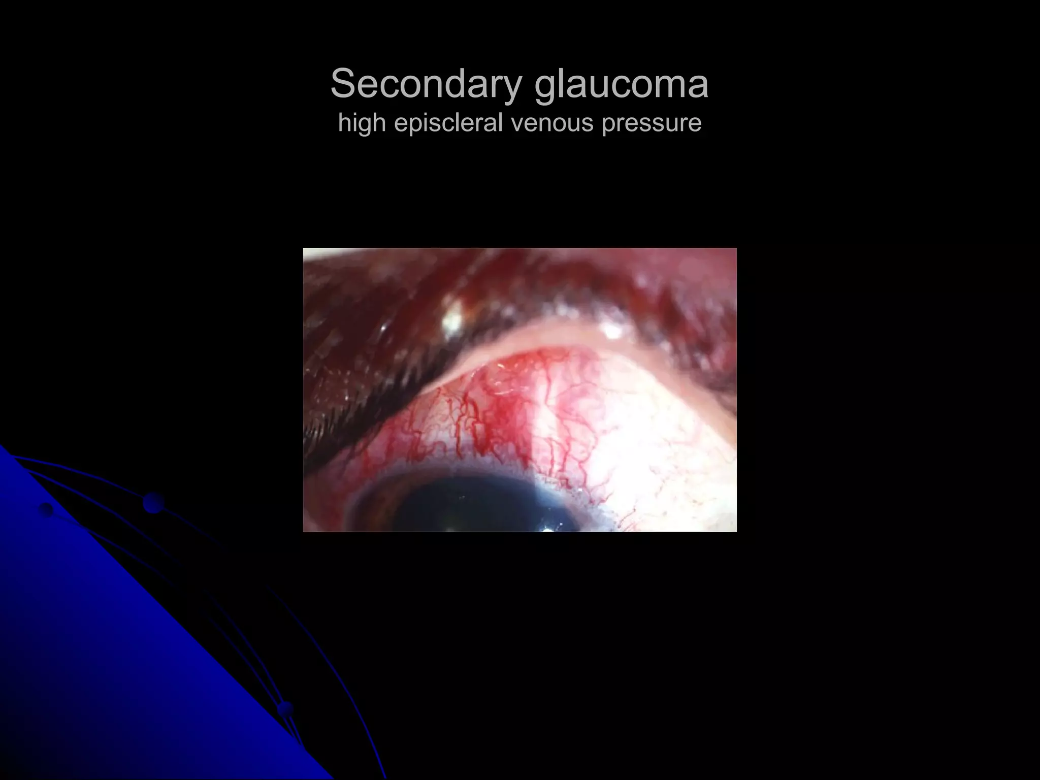 Secondary glaucoma | PPT