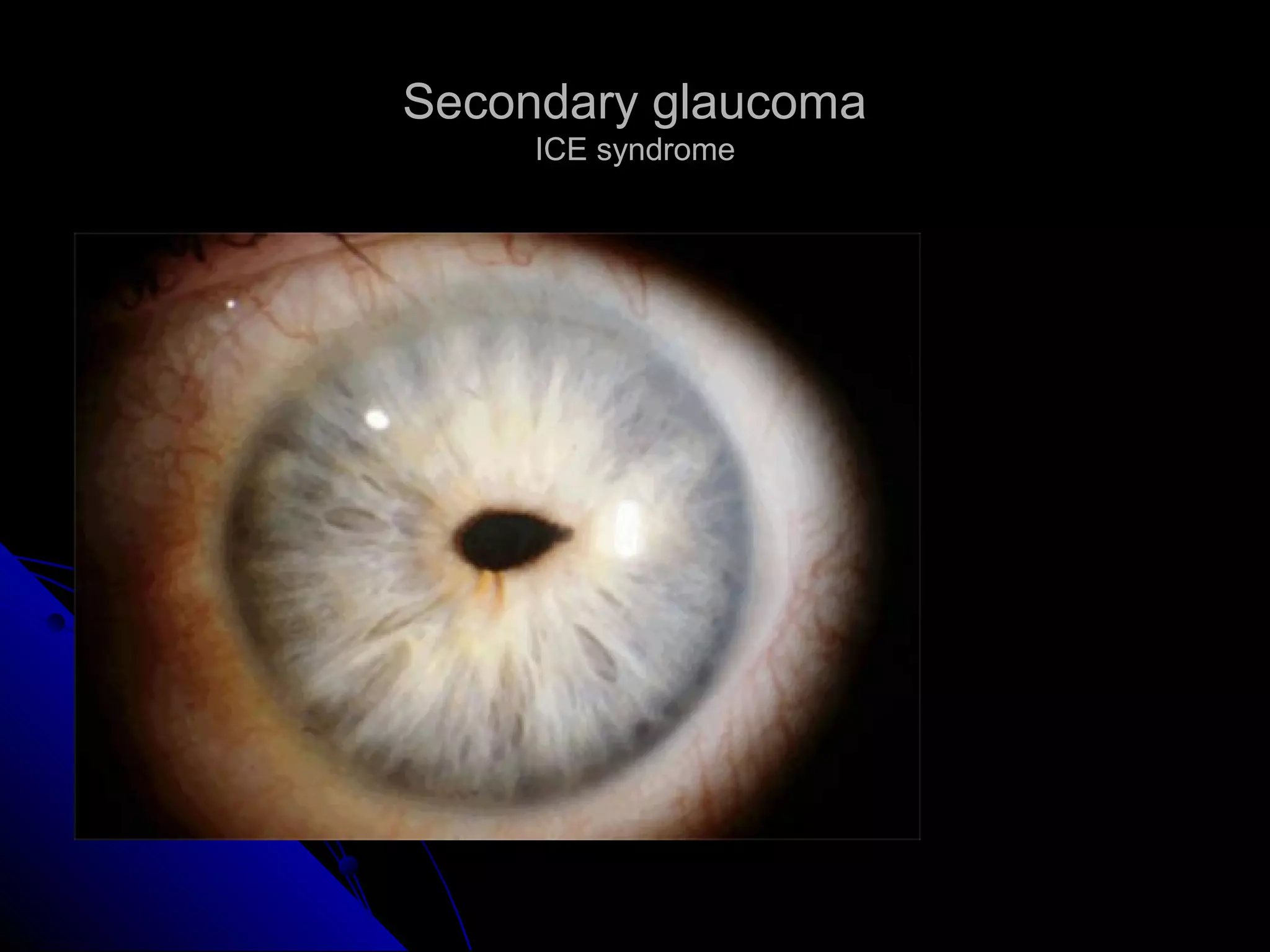 Secondary glaucoma | PPT