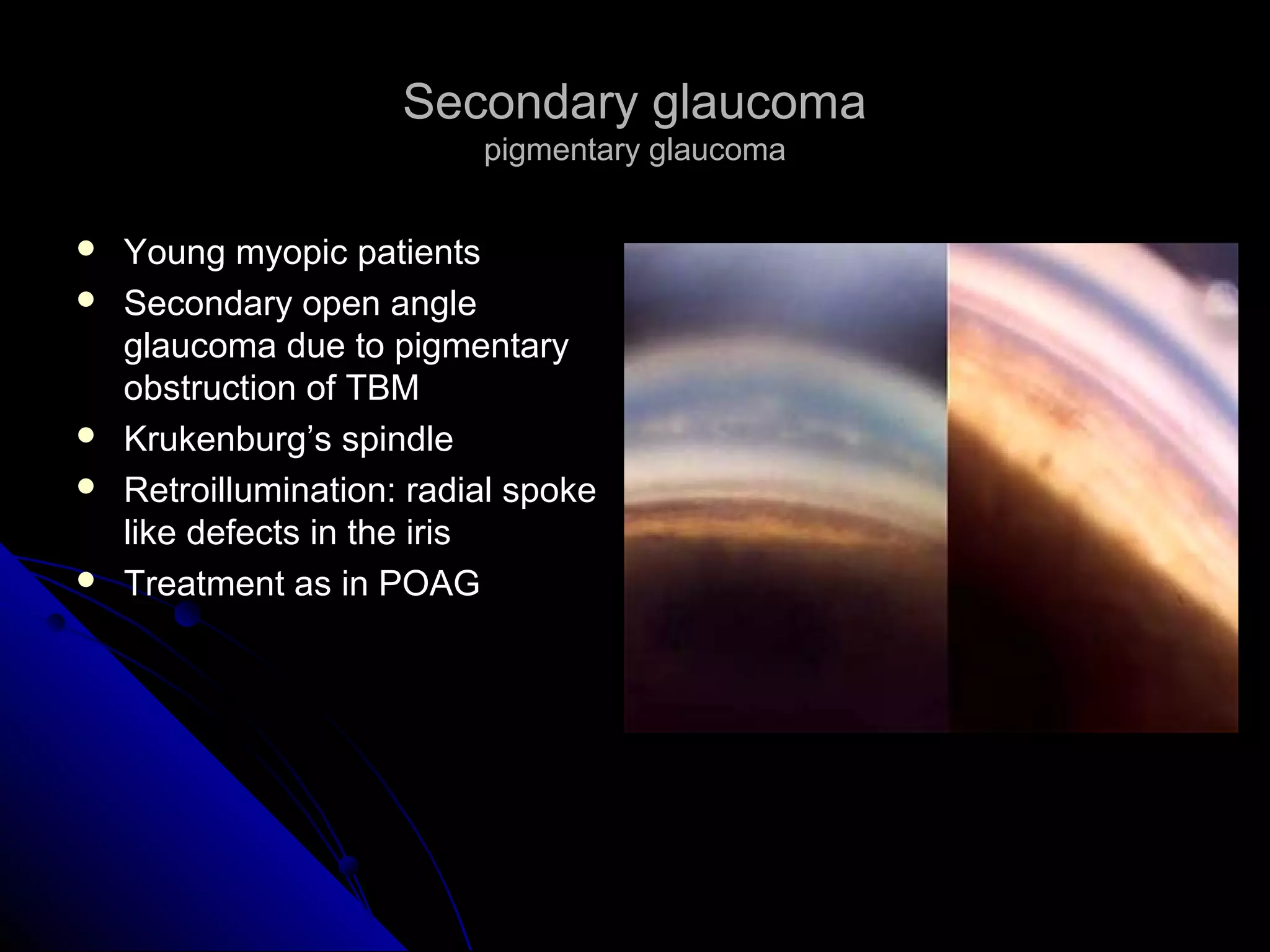 Secondary glaucoma | PPT