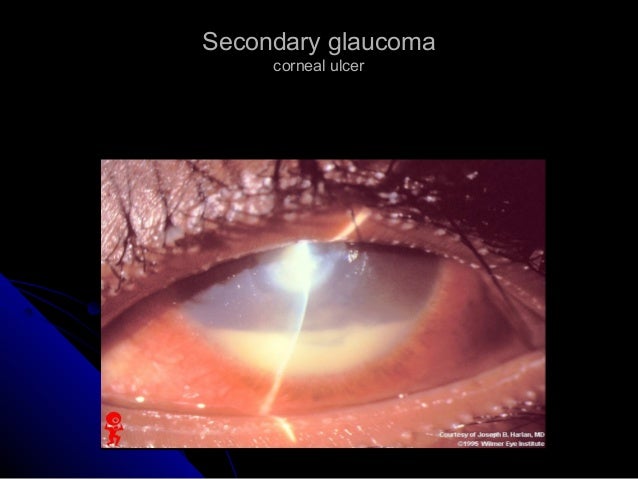Secondary glaucoma
