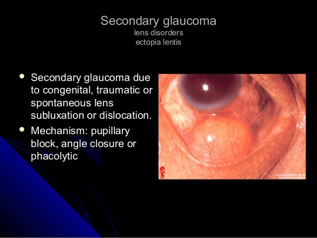 Secondary Glaucoma