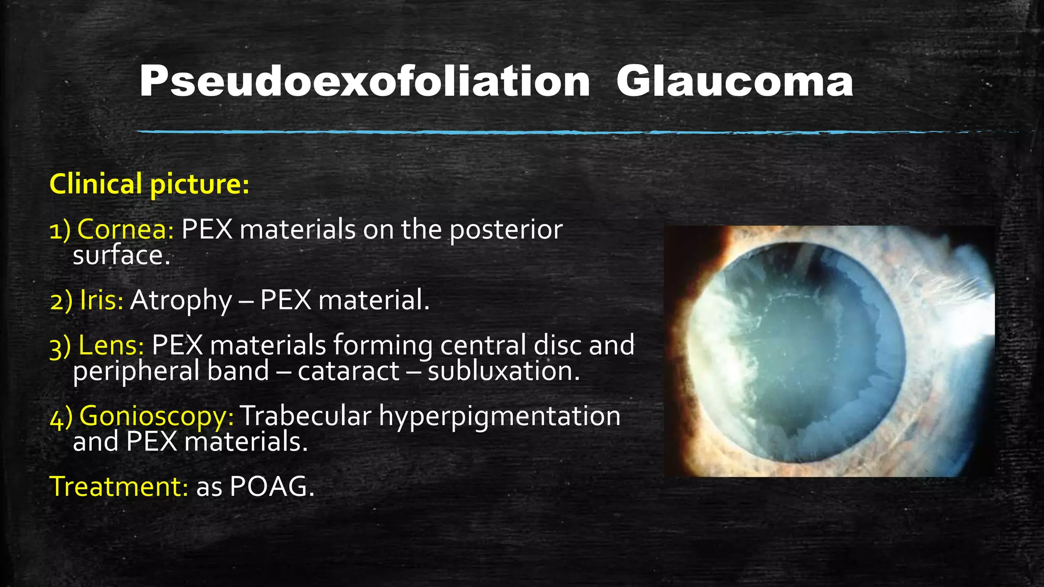 Secondary glaucoma | PPTX