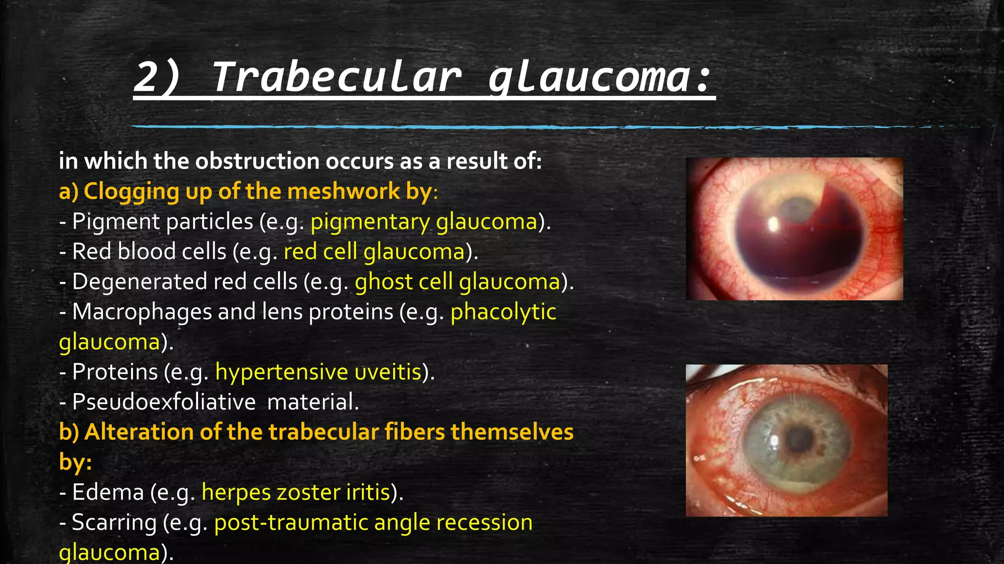 Secondary glaucoma | PPTX