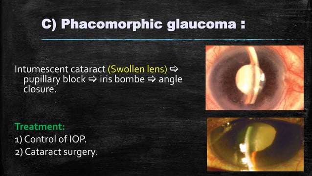Secondary glaucoma | PPTX