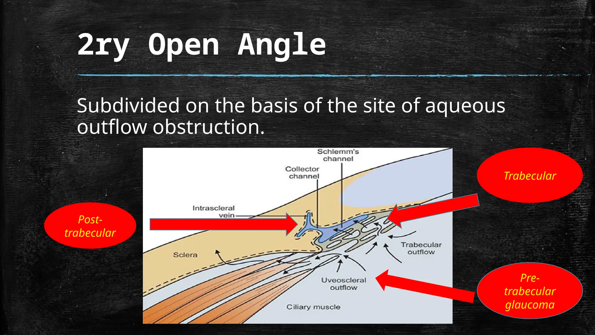 Secondary glaucoma an overview about glaucoma | PPTX