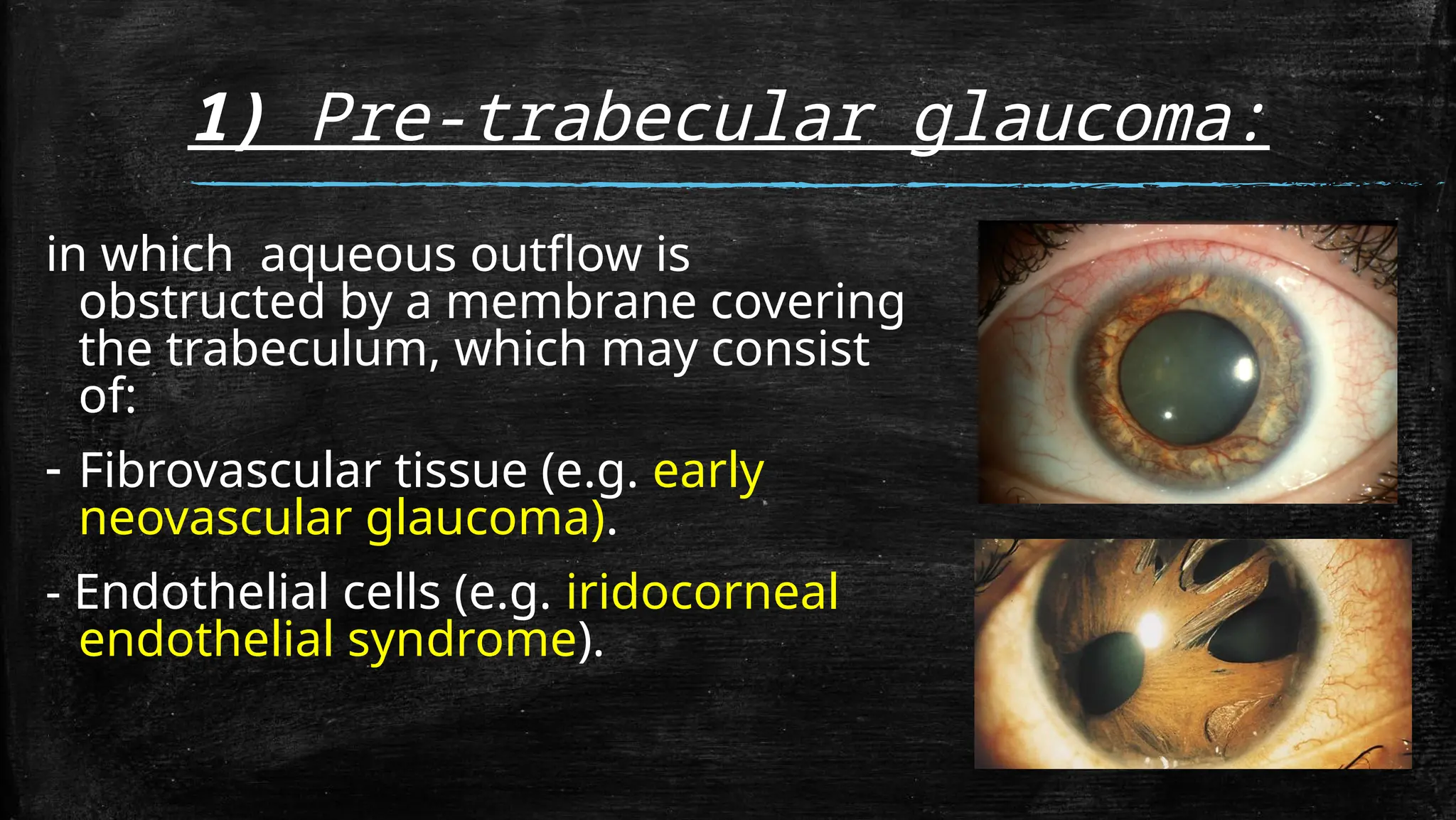 Secondary glaucoma an overview about glaucoma | PPTX