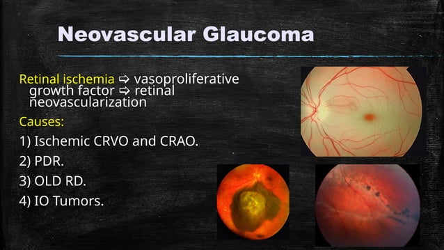 Secondary glaucoma an overview about glaucoma | PPTX