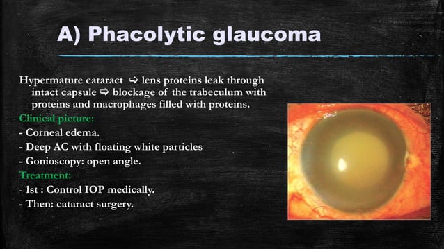 Secondary glaucoma an overview about glaucoma | PPTX