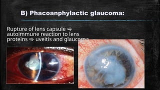 Secondary glaucoma an overview about glaucoma | PPT