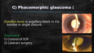 Secondary glaucoma an overview about glaucoma | PPTX