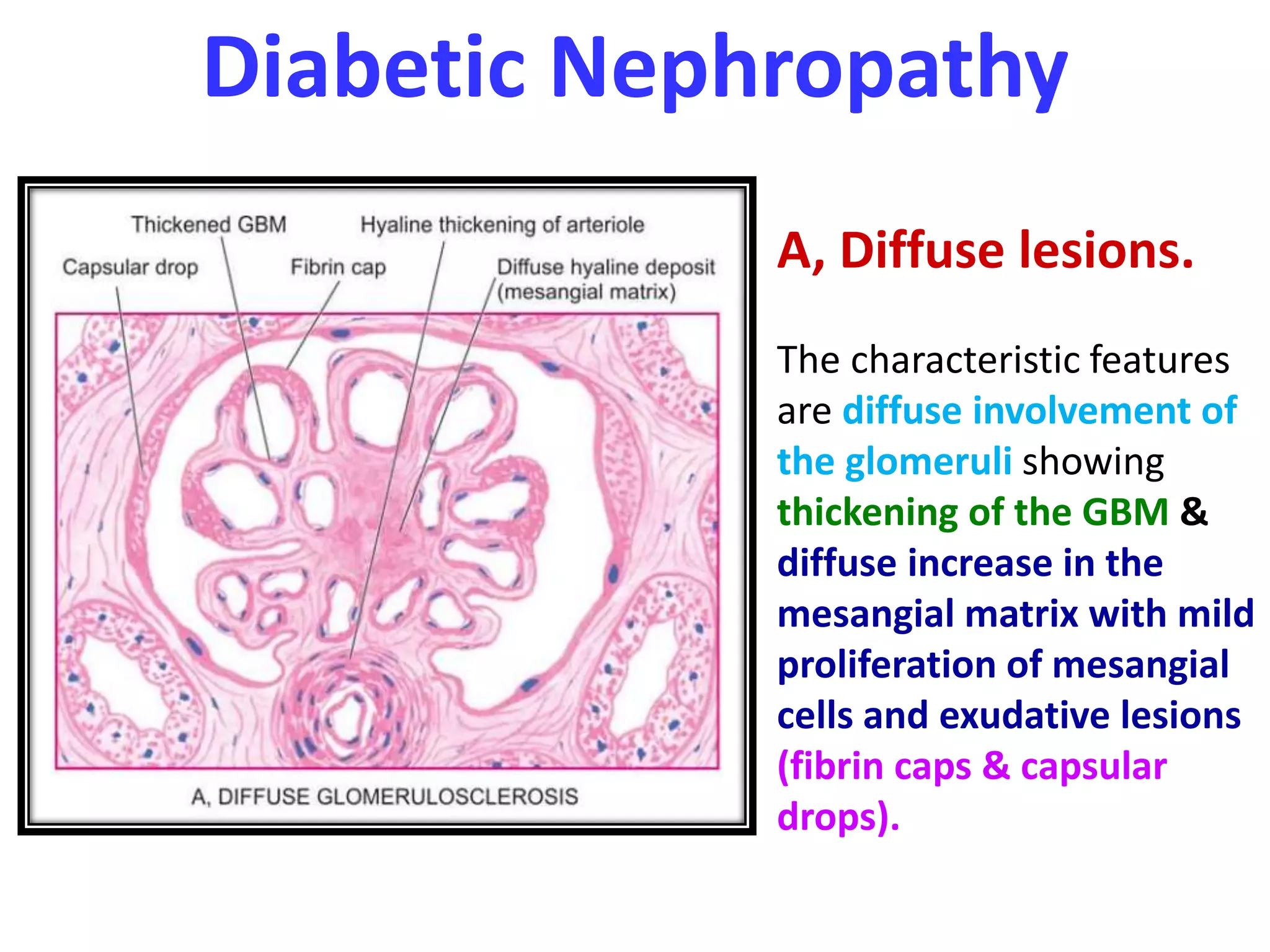 Secondary glomerular diseases | PPTX