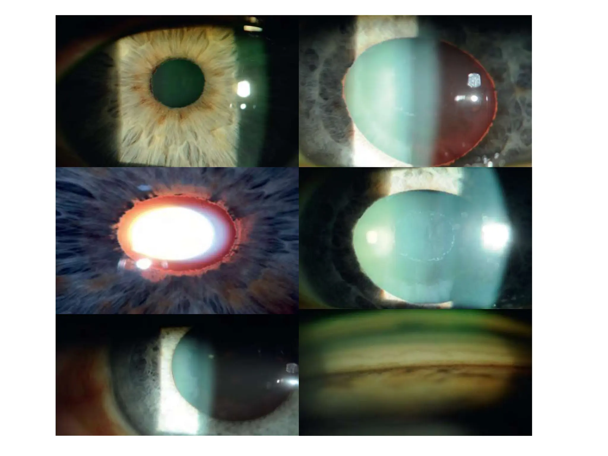 secondary gluacoma classifications and brief explanation.pptx