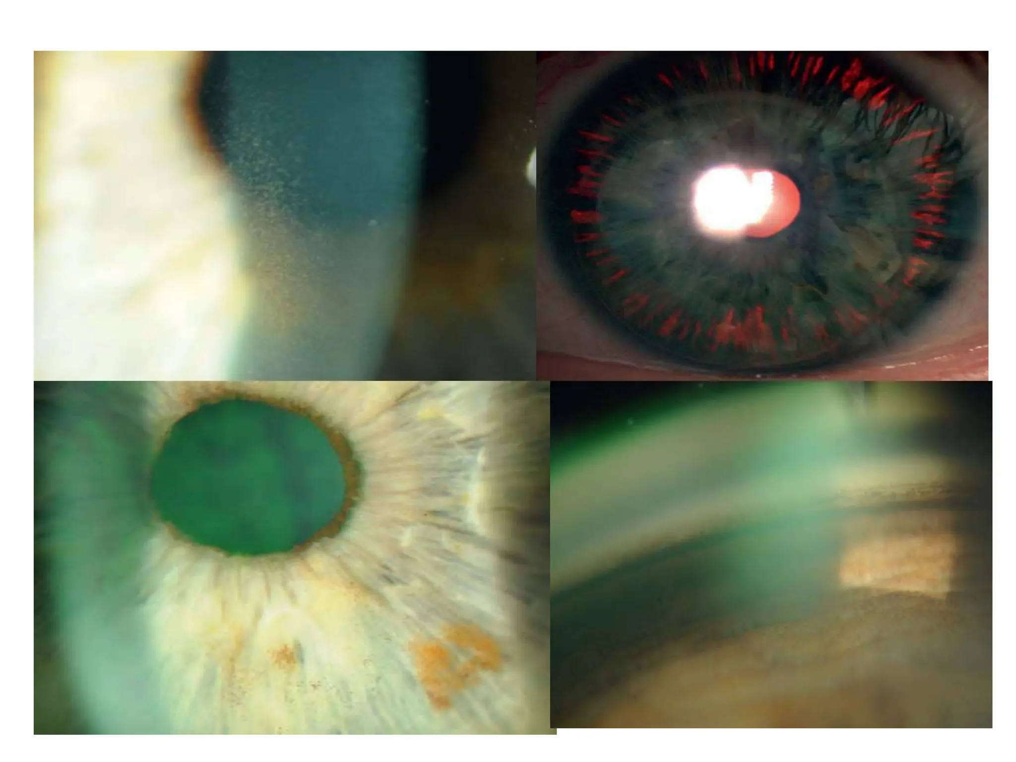 secondary gluacoma classifications and brief explanation.pptx