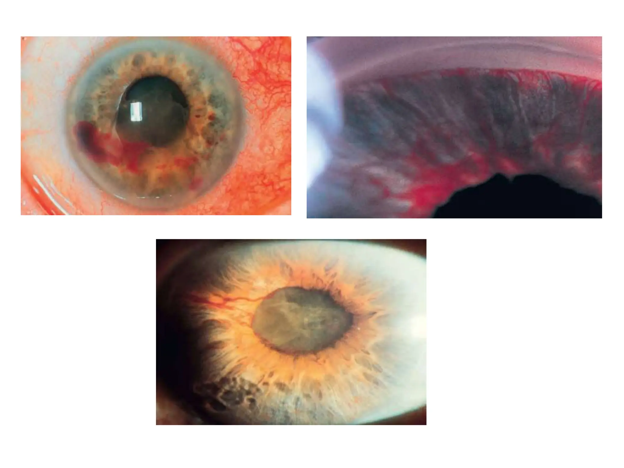 secondary gluacoma classifications and brief explanation.pptx
