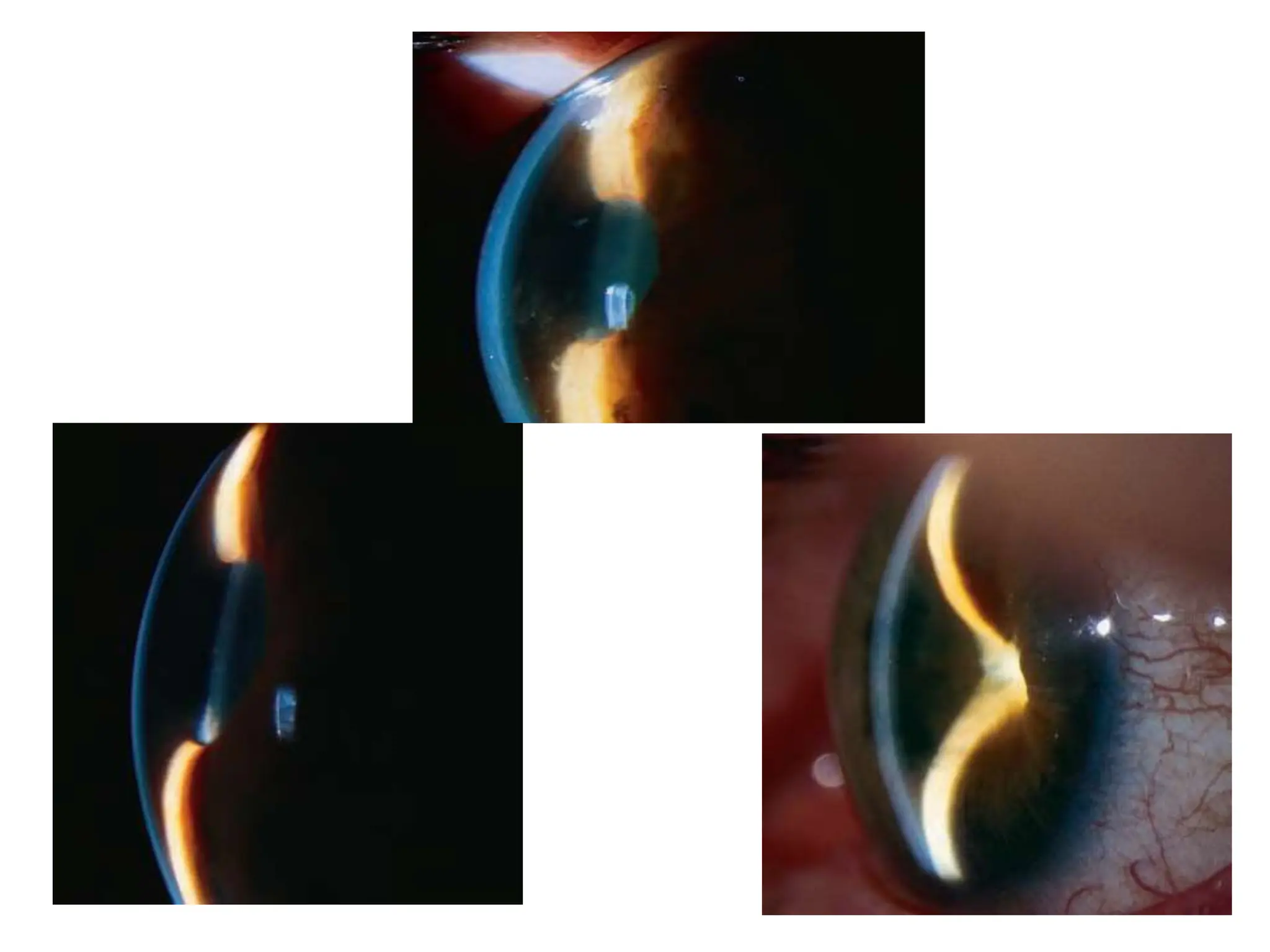 secondary gluacoma classifications and brief explanation.pptx