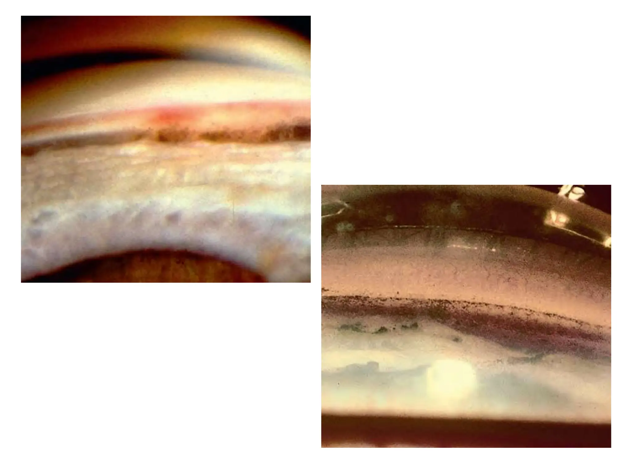 secondary gluacoma classifications and brief explanation.pptx