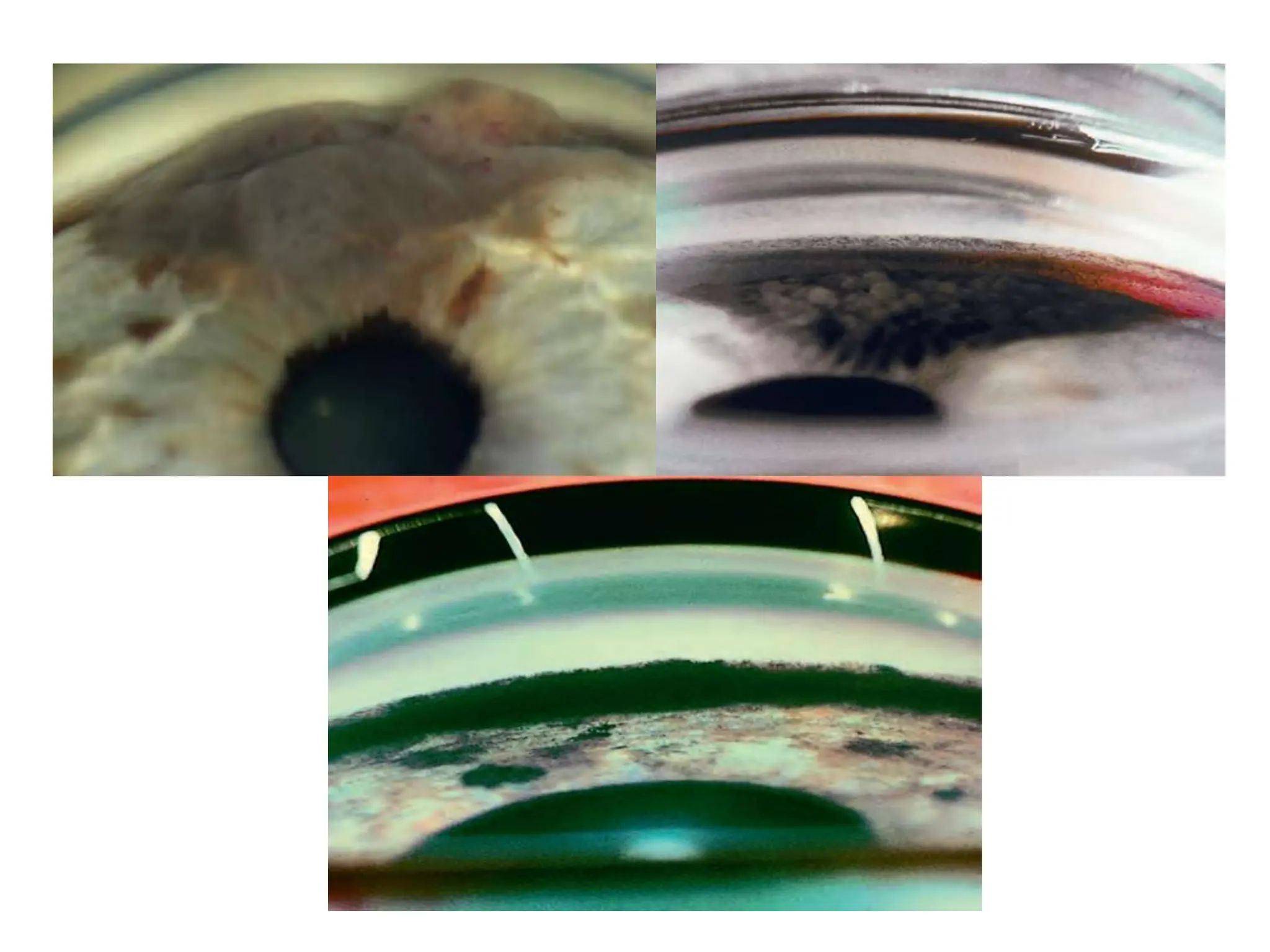 secondary gluacoma classifications and brief explanation.pptx