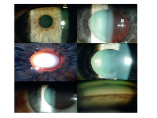 secondary gluacoma classifications and brief explanation.pptx