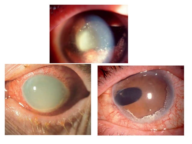 secondary gluacoma classifications and brief explanation.pptx